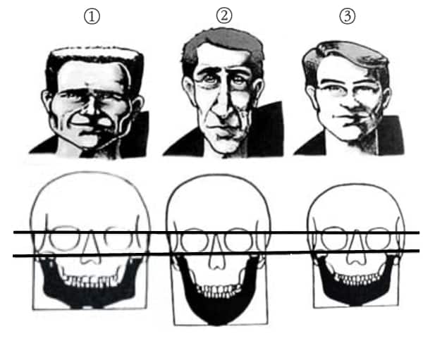 Abfracción Dental: Causas y Tratamiento | Solución Dental | Dentistas ...