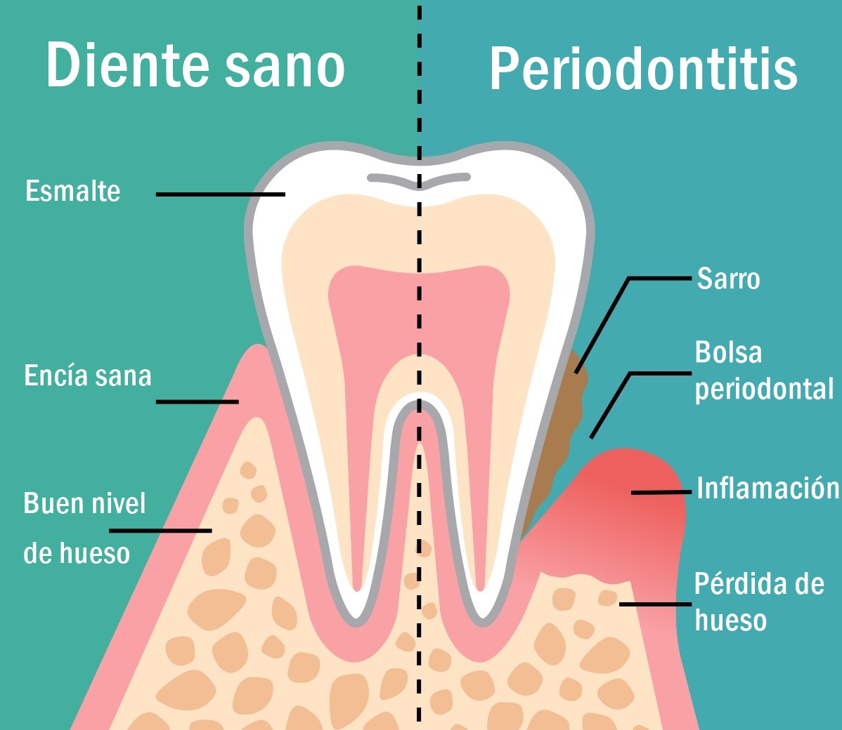 Curetaje Dental ¿Qué es y cuándo se realiza? | Solución Dental